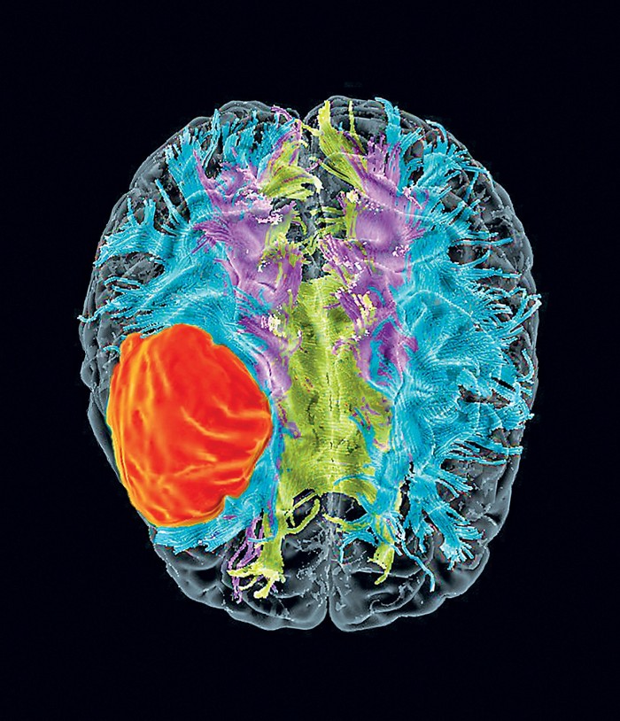 Sex Differences In Glioblastoma Brain Tumors Revealed By Analysis Of Patient Imaging