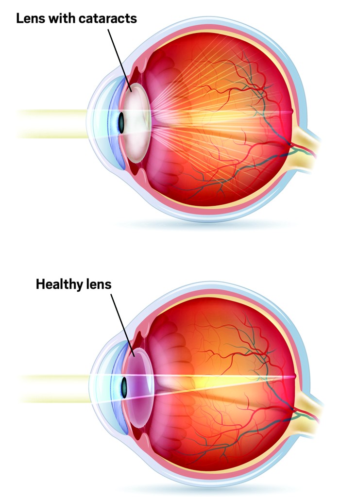 Amyloids found in human cataracts