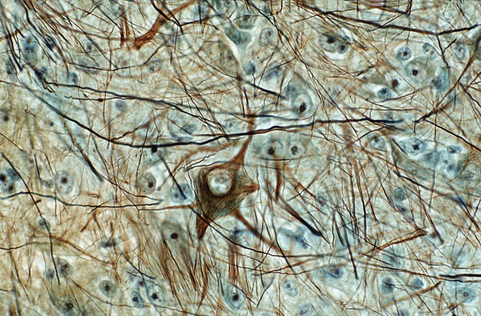 Biogen’s ALS drug falters in Phase 3 trials